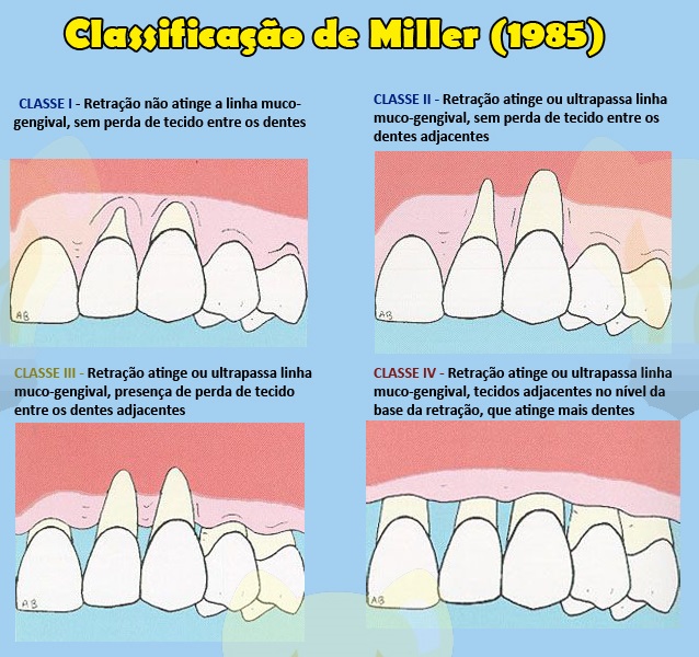 Classificação de Miller – Retracção Gengival – O Higienista Oral Blog
